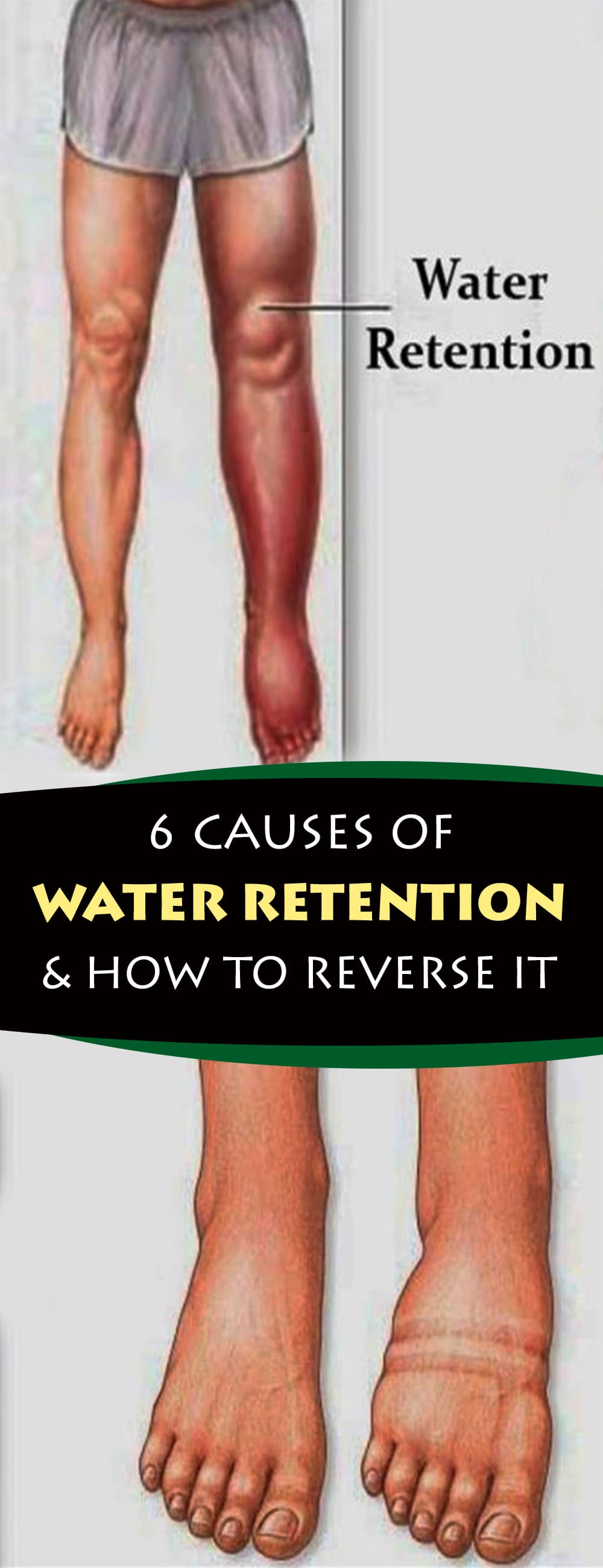 6 Causes of Water Retention and How to Reverse It - Health Overdosed